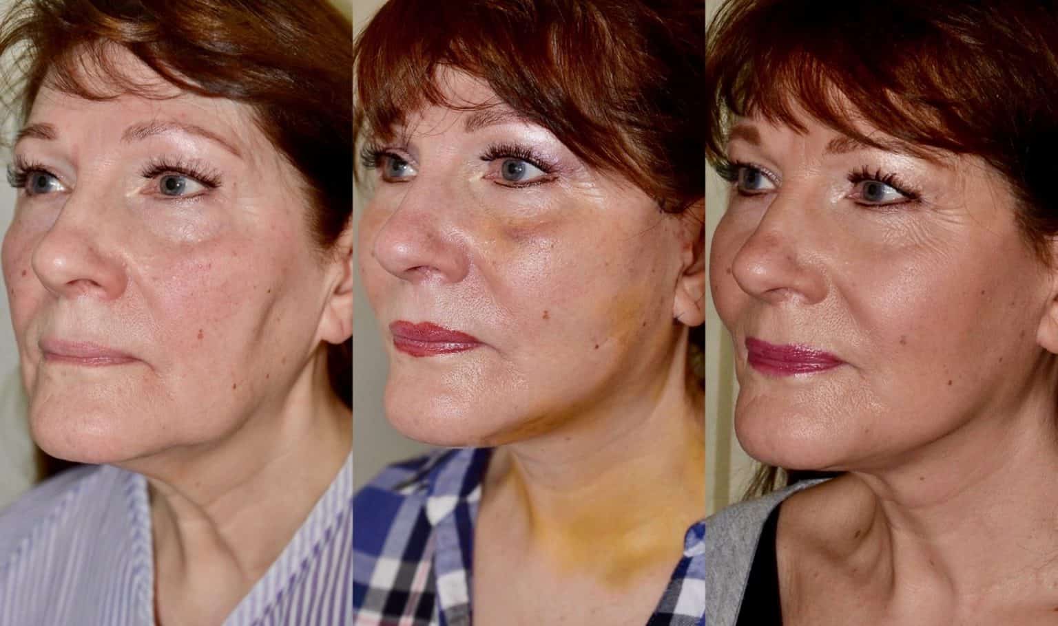 Facelift Before and After Photos | Quaba UK