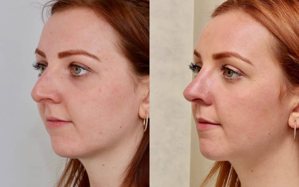 Before and After Rhinoplasty Photos | Quaba Cosmetic Surgery UK