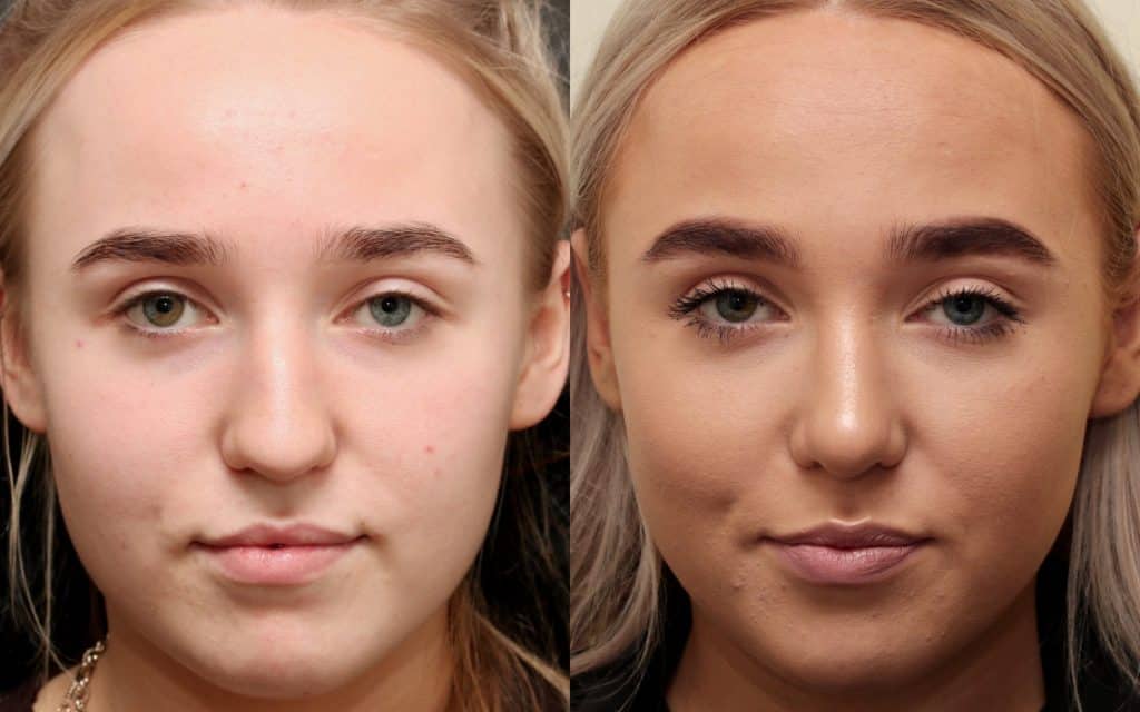 Before and After Rhinoplasty Photos | Quaba Cosmetic Surgery UK