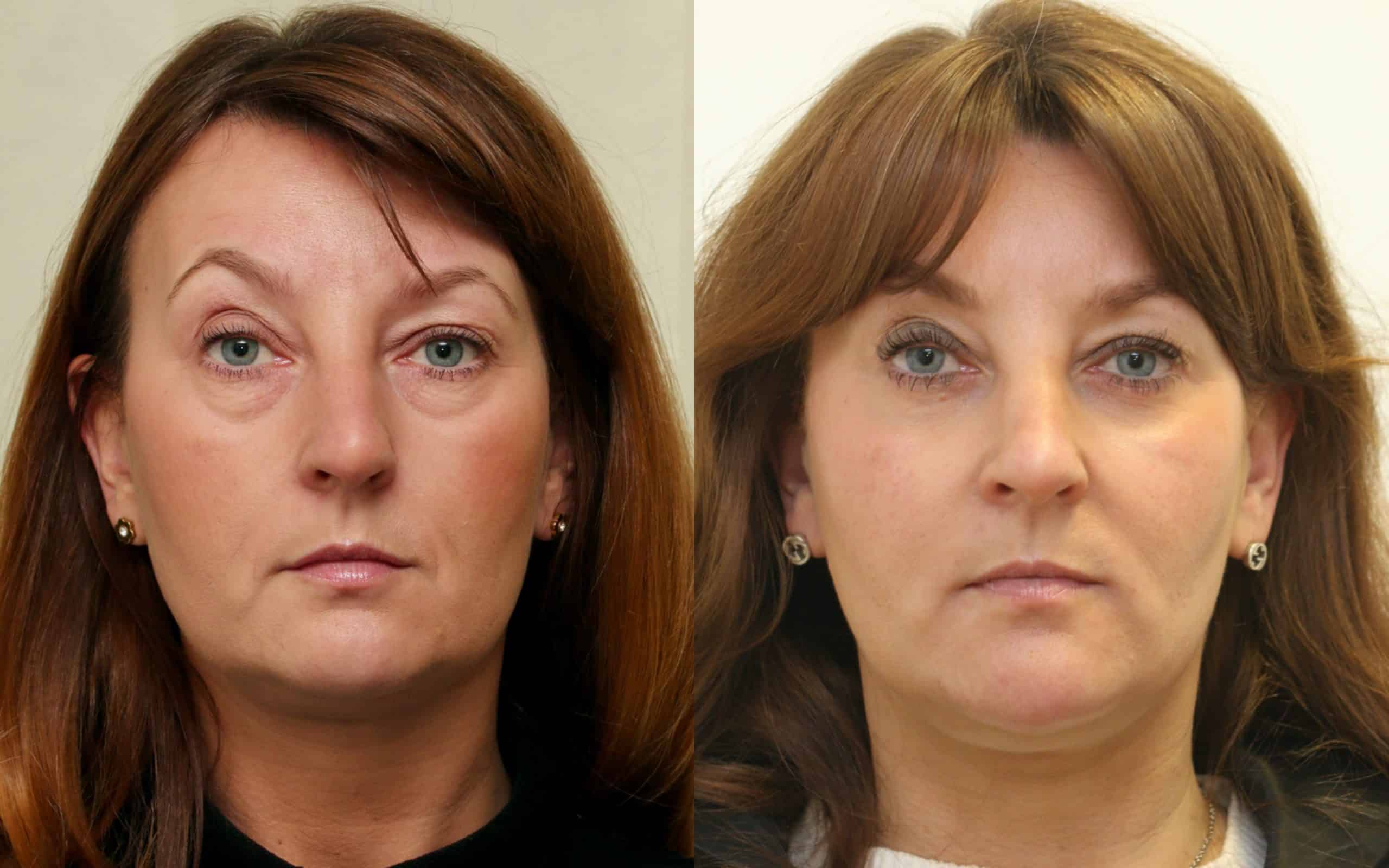 Upper Blepharoplasty Before After