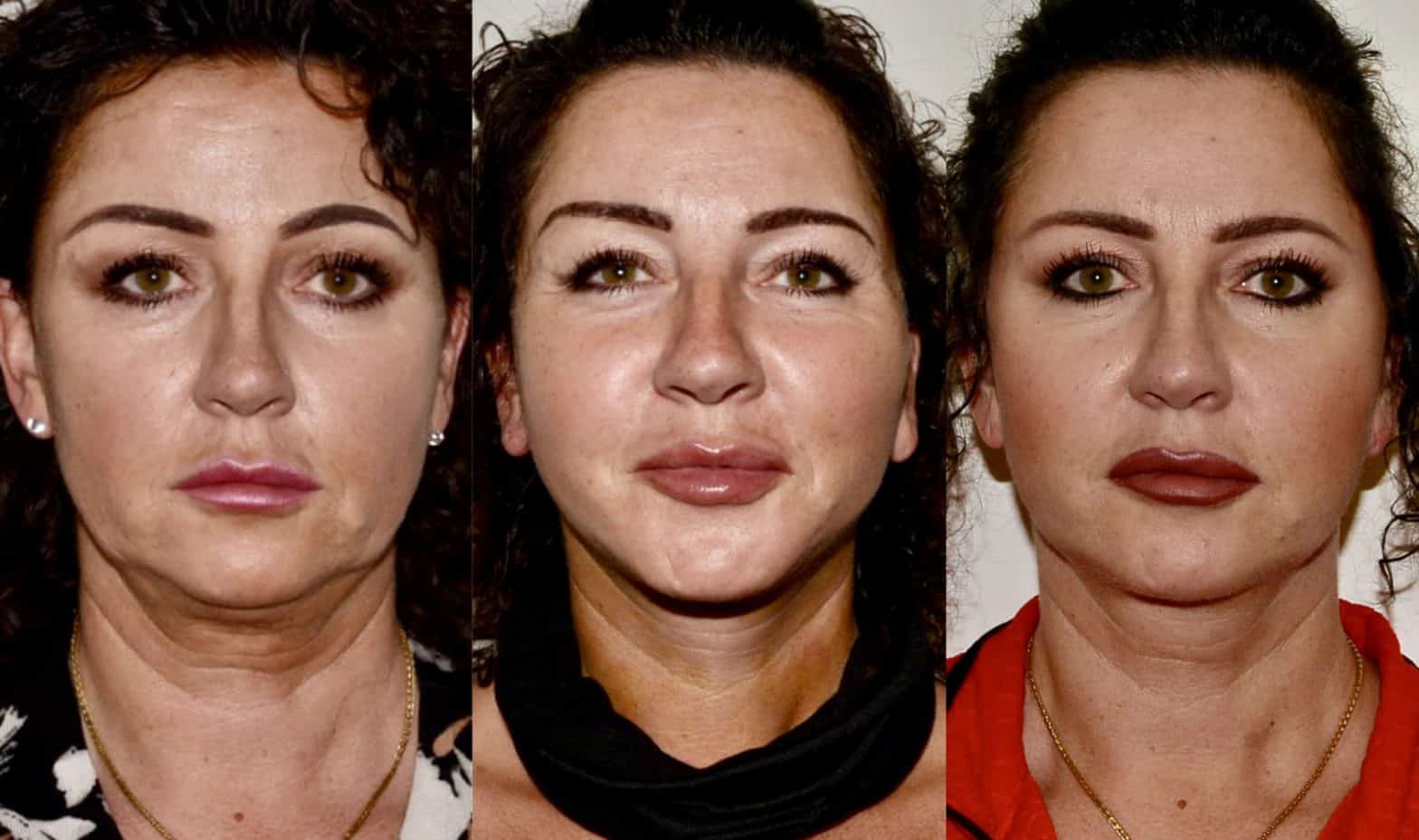 Facelift Before and After Photos | Quaba UK