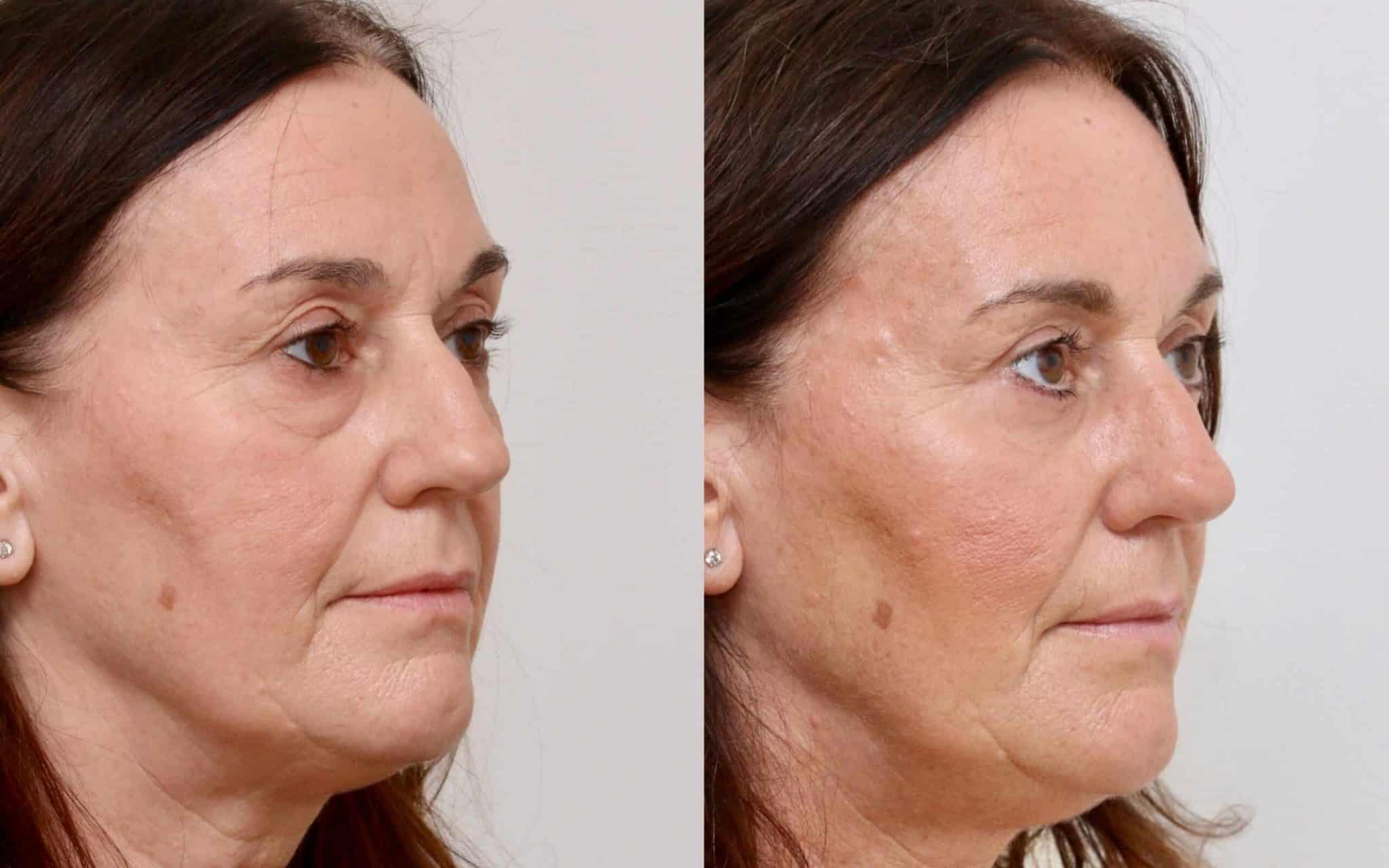 Eyelid Surgery Results Edinburgh | Scotland Gallery