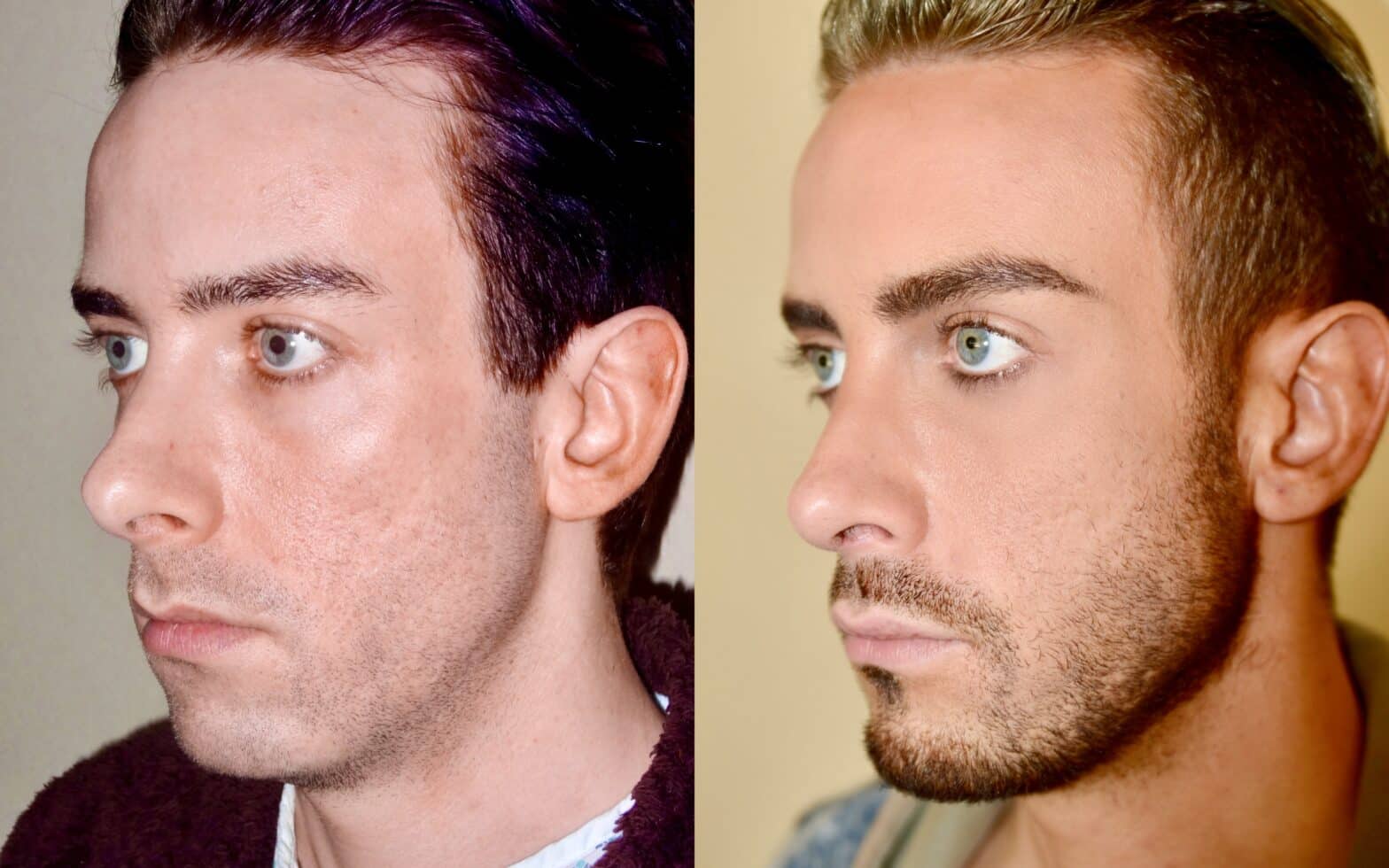Chin Implant Before and Afters - See Results | Quaba Cosmetic Surgery