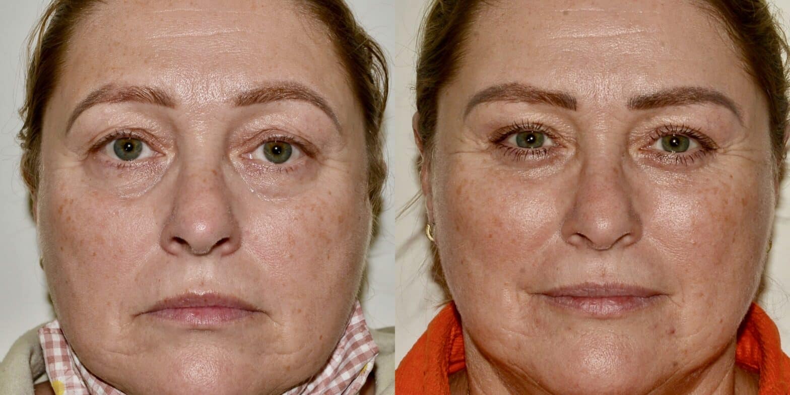 Brow Lift Before & Afters | Quaba Plastic Surgery Edinburgh