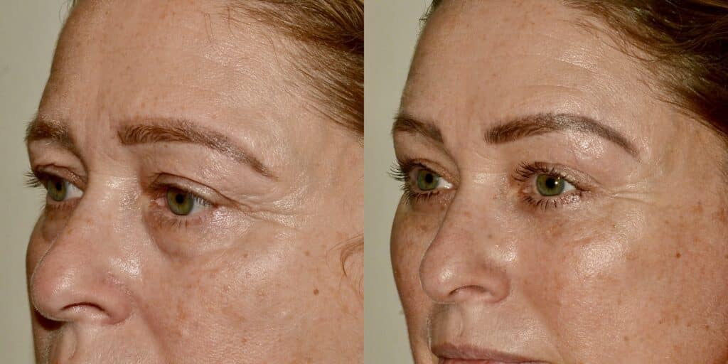 Brow Lift Before & Afters | Quaba Plastic Surgery Edinburgh