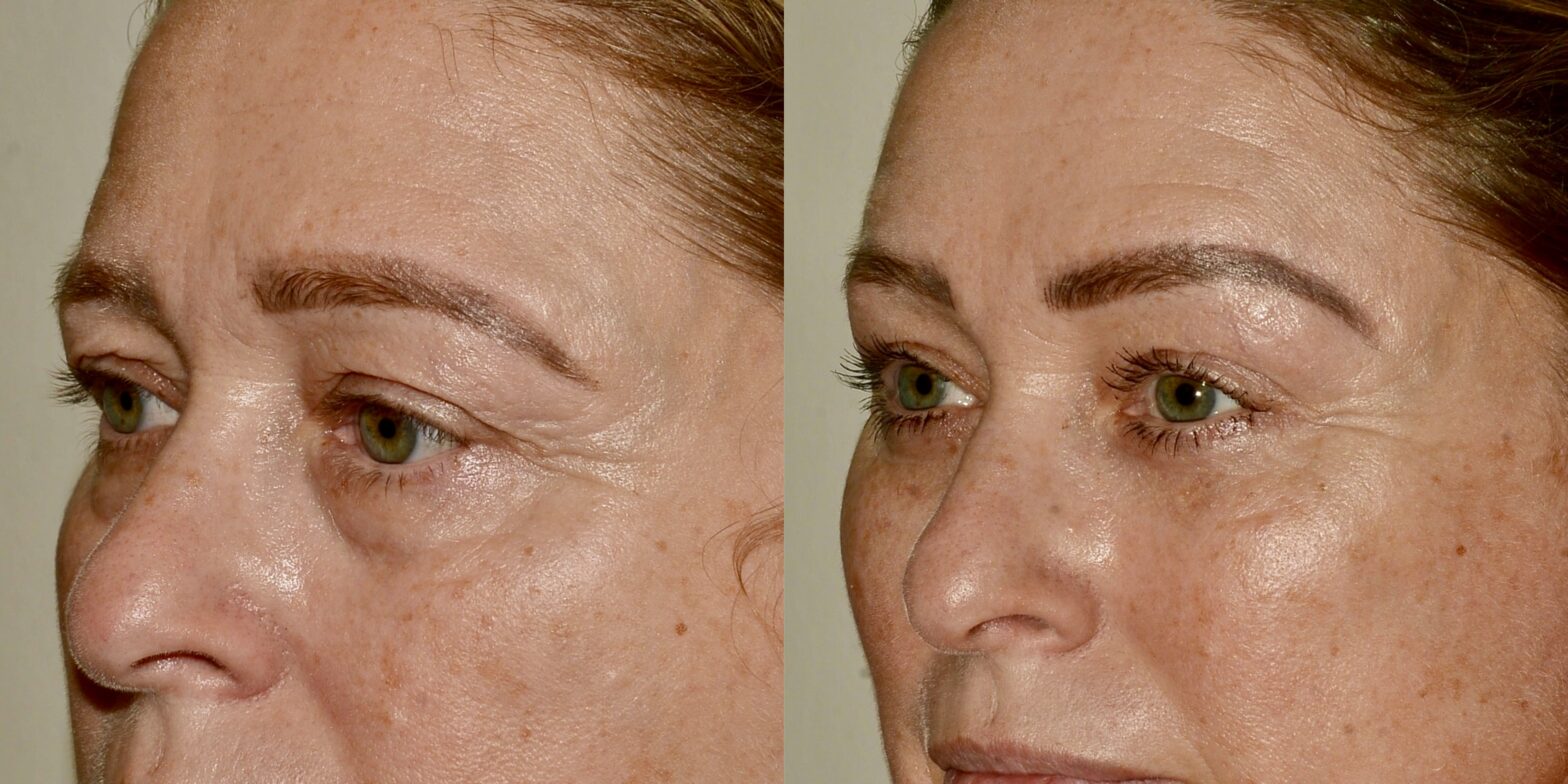 Brow Lift Before & Afters | Quaba Plastic Surgery Edinburgh