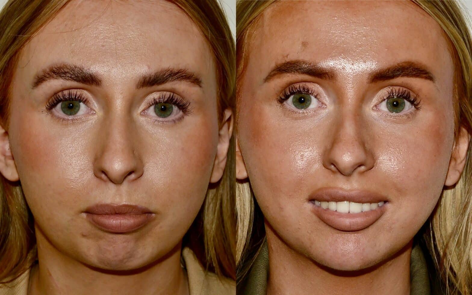 Chin Implant Before and Afters - See Results | Quaba Cosmetic Surgery