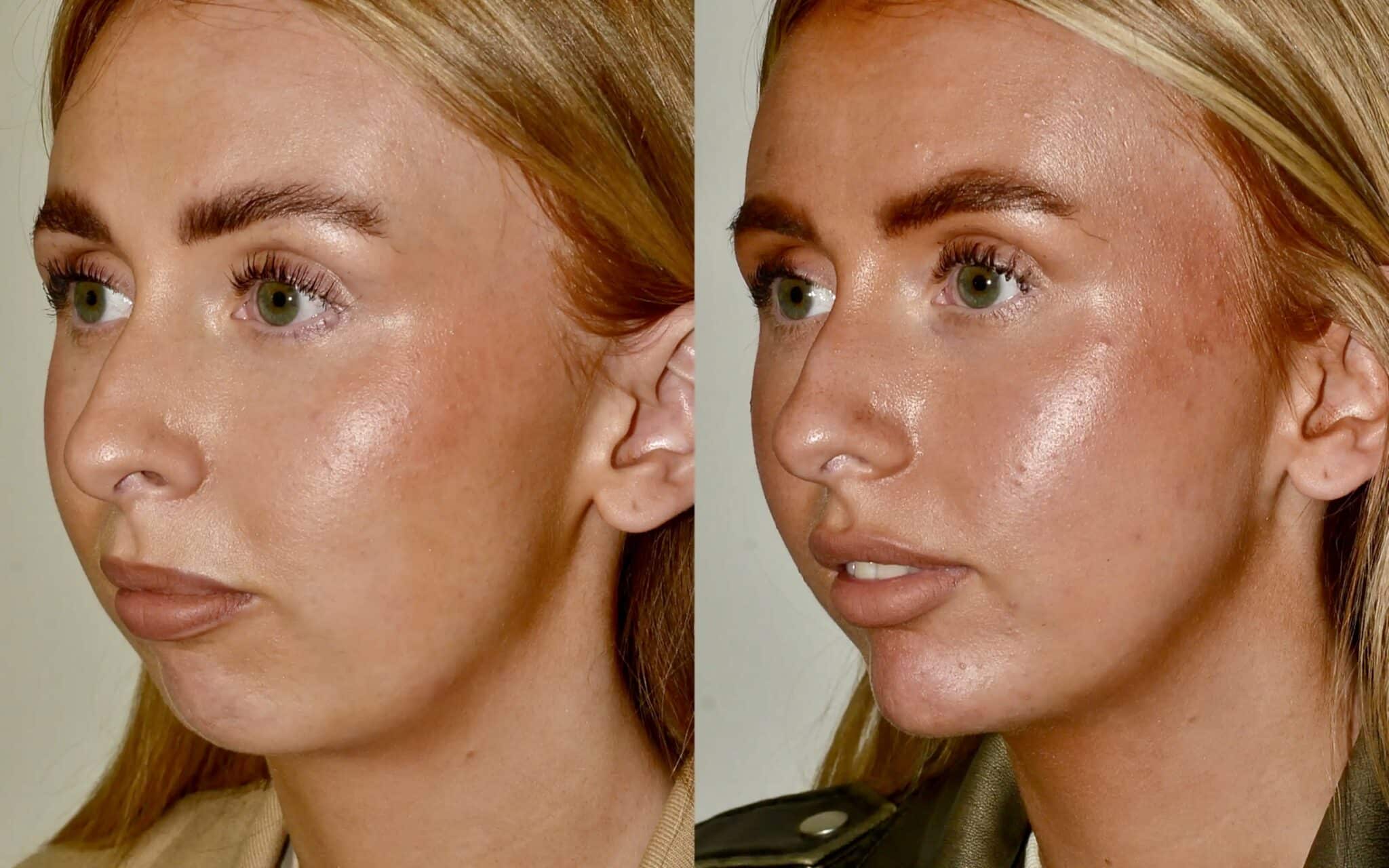 Chin Implant Before and Afters - See Results | Quaba Cosmetic Surgery