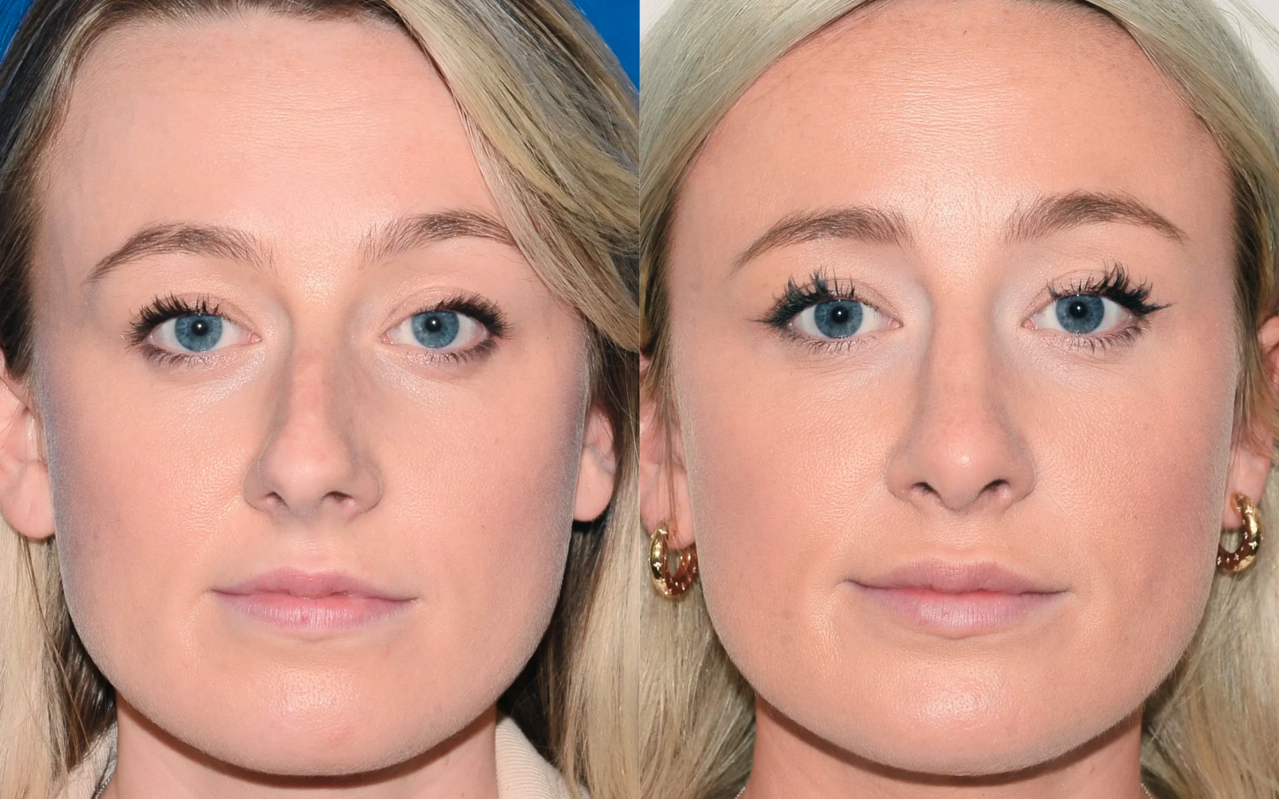Before and After Rhinoplasty Photos | Quaba Cosmetic Surgery UK