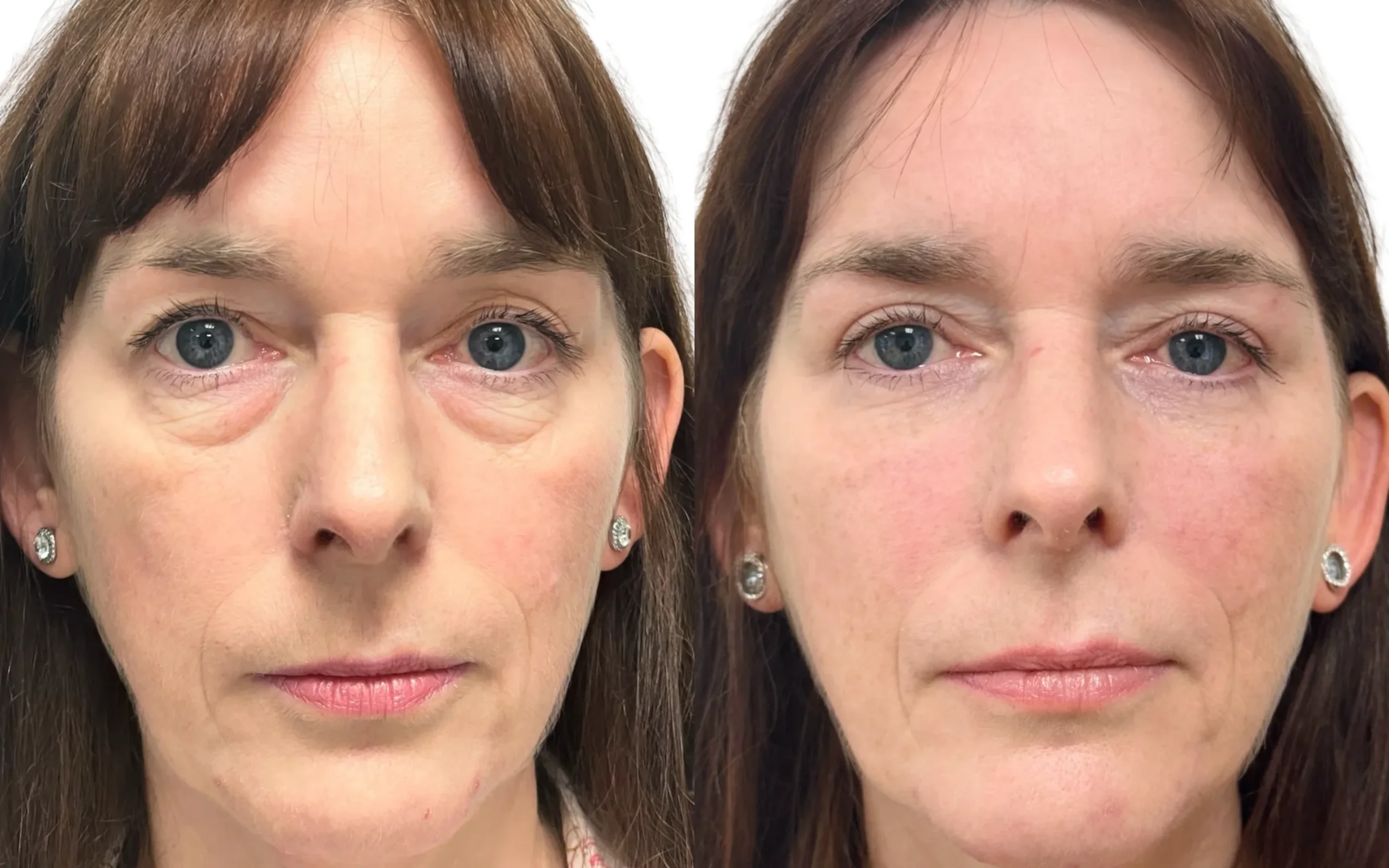 Eyelid Surgery Results Edinburgh | Scotland Gallery
